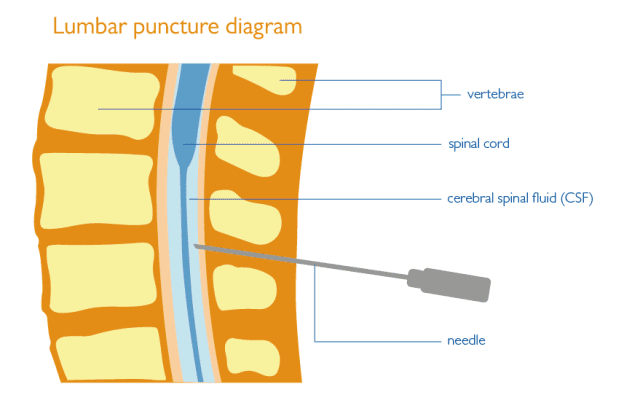 Lumbar Puncture Fact Sheet Health Information Brain And Spine