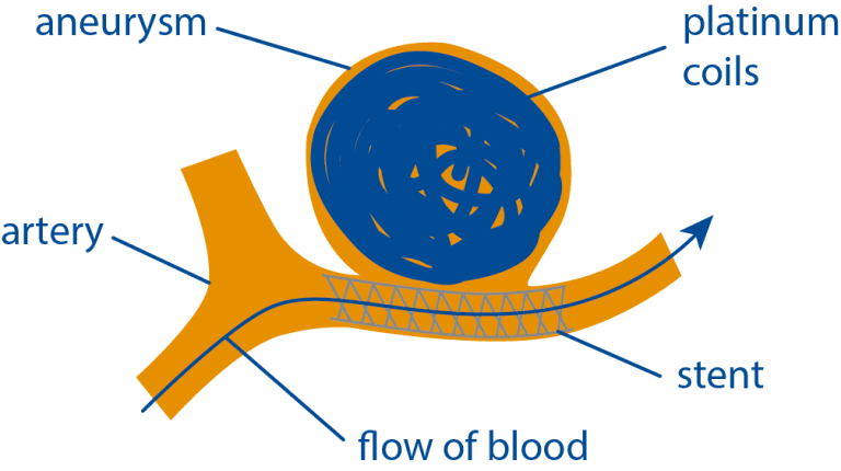 Coiling of Brain Aneurysms | Fact Sheet | Health Information | Brain ...