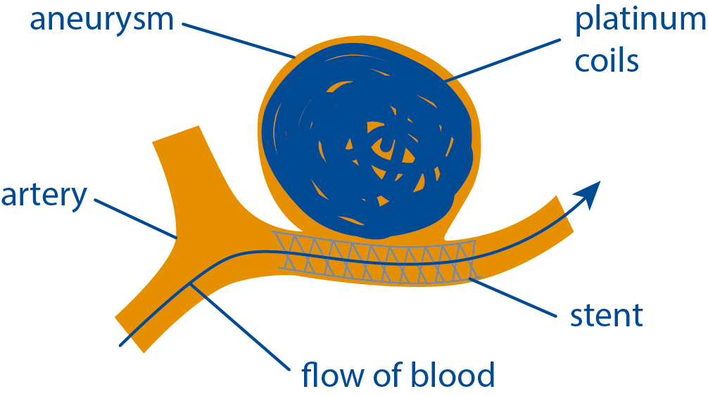 Coiling of Brain Aneurysms | Fact Sheet | Health Information | Brain ...