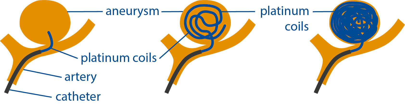 Coiling of Brain Aneurysms | Fact Sheet | Health Information | Brain ...