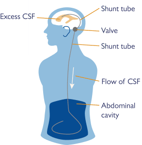 Hydrocephalus and Shunts | Fact Sheet | Health Information | Brain ...