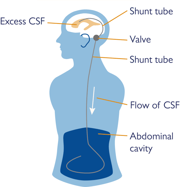 Hydrocephalus and Shunts | Fact Sheet | Health Information | Brain ...