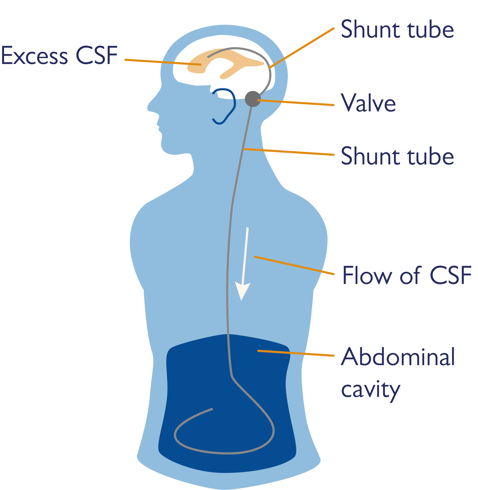 Hydrocephalus and Shunts | Fact Sheet | Health Information | Brain ...